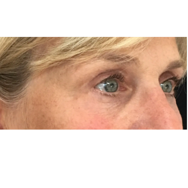 Best Blepharoplasty in Liverpool | Eyelid Surgery Liverpool